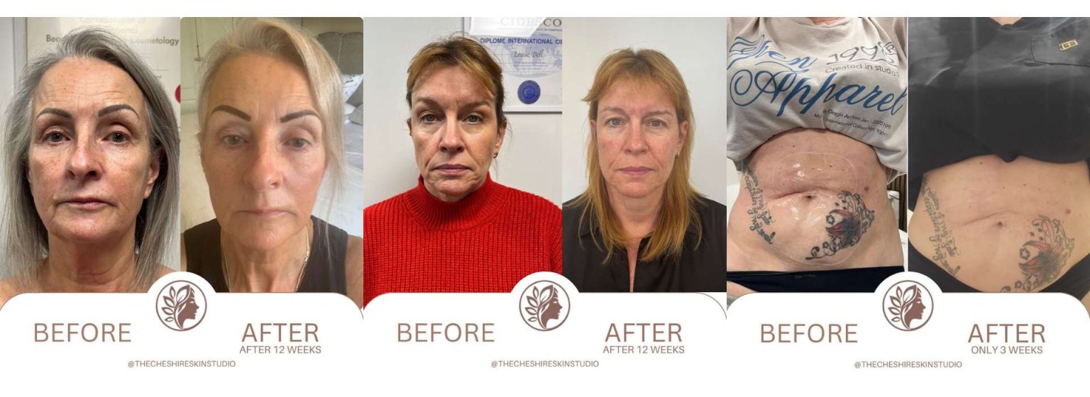 HIFU Before After Photos | Witness The Incredible Results