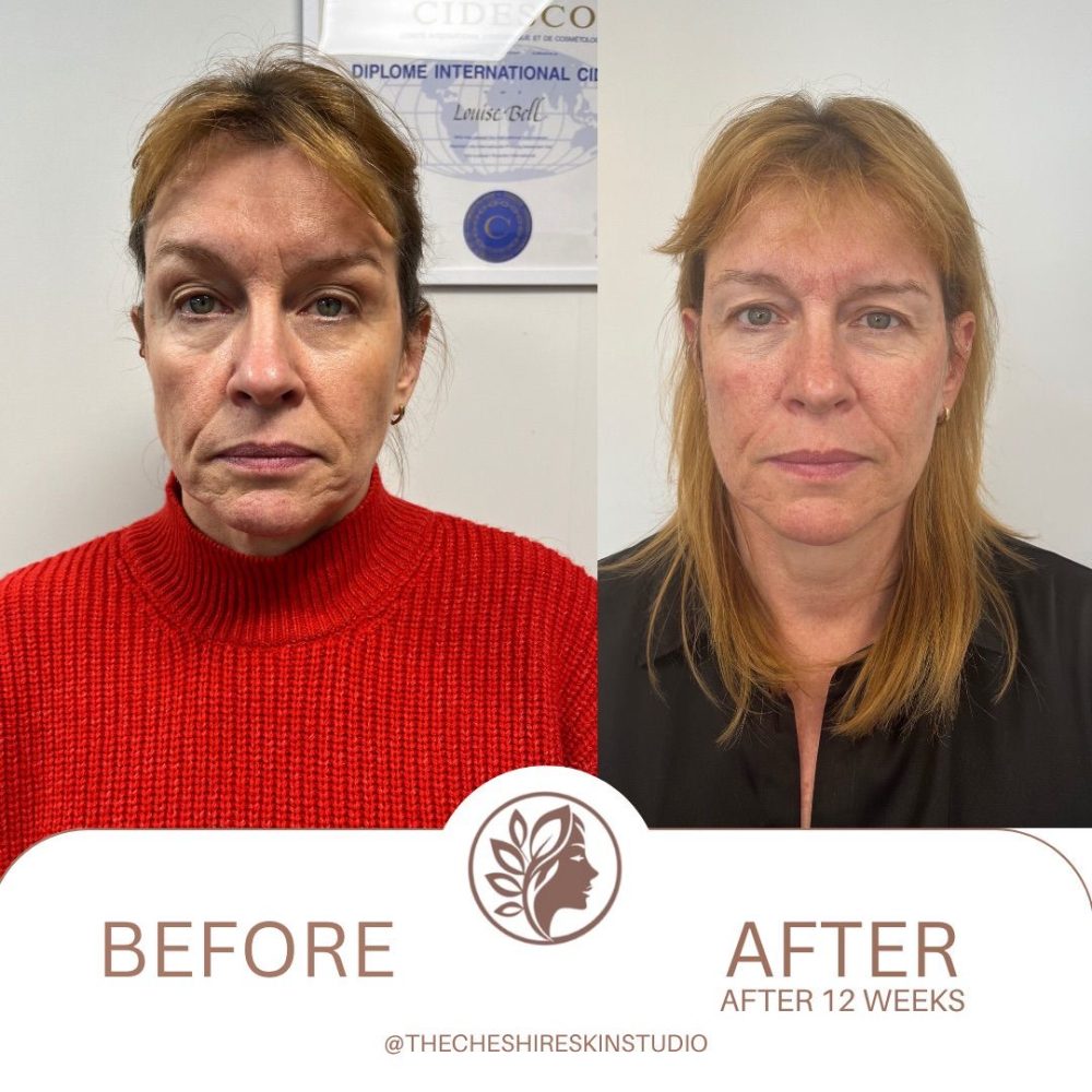 HIFU Before After Photos | Witness The Incredible Results