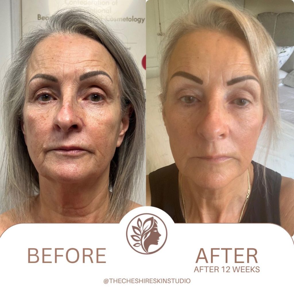 HIFU Before After Photos | Witness The Incredible Results