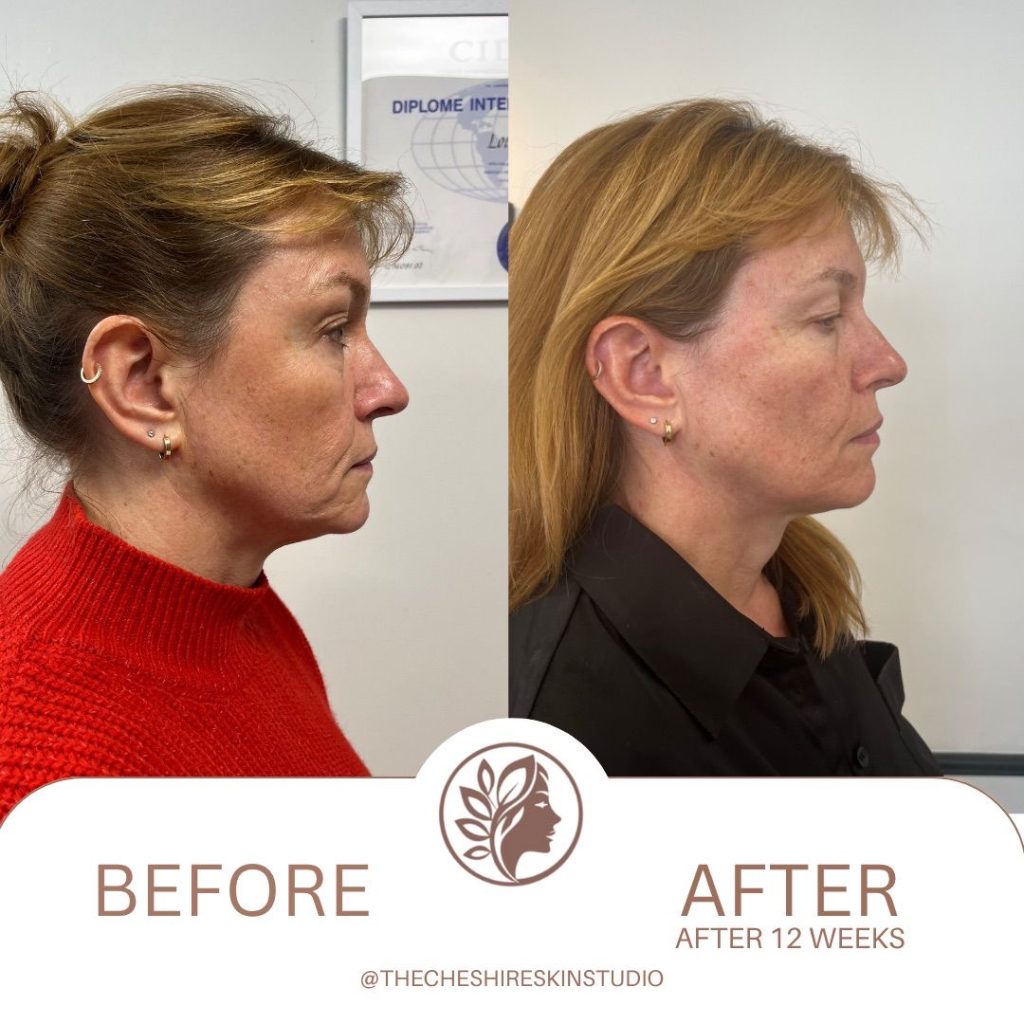 HIFU Before After Photos | Witness The Incredible Results